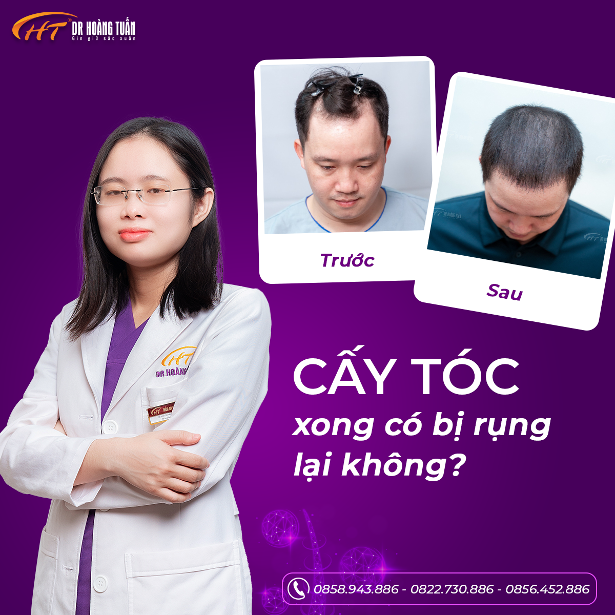 CHUYÊN GIA CẤY TÓC GIẢI ĐÁP THẮC MẮC: CẤY TÓC XONG CÓ BỊ RỤNG LẠI KHÔNG?